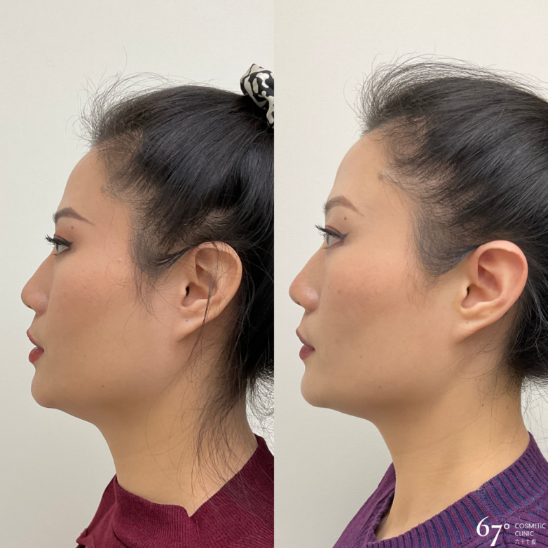 Lipodissolve - 67 Degrees Cosmetic Clinic