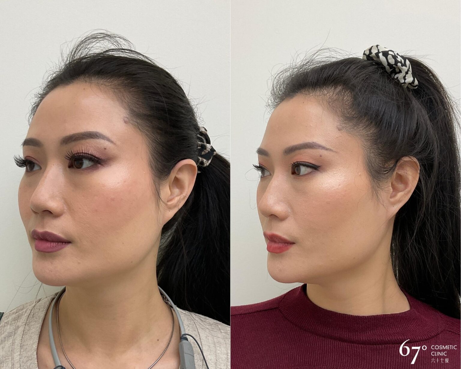 Face Slimming | Botox Vancouver | Richmond