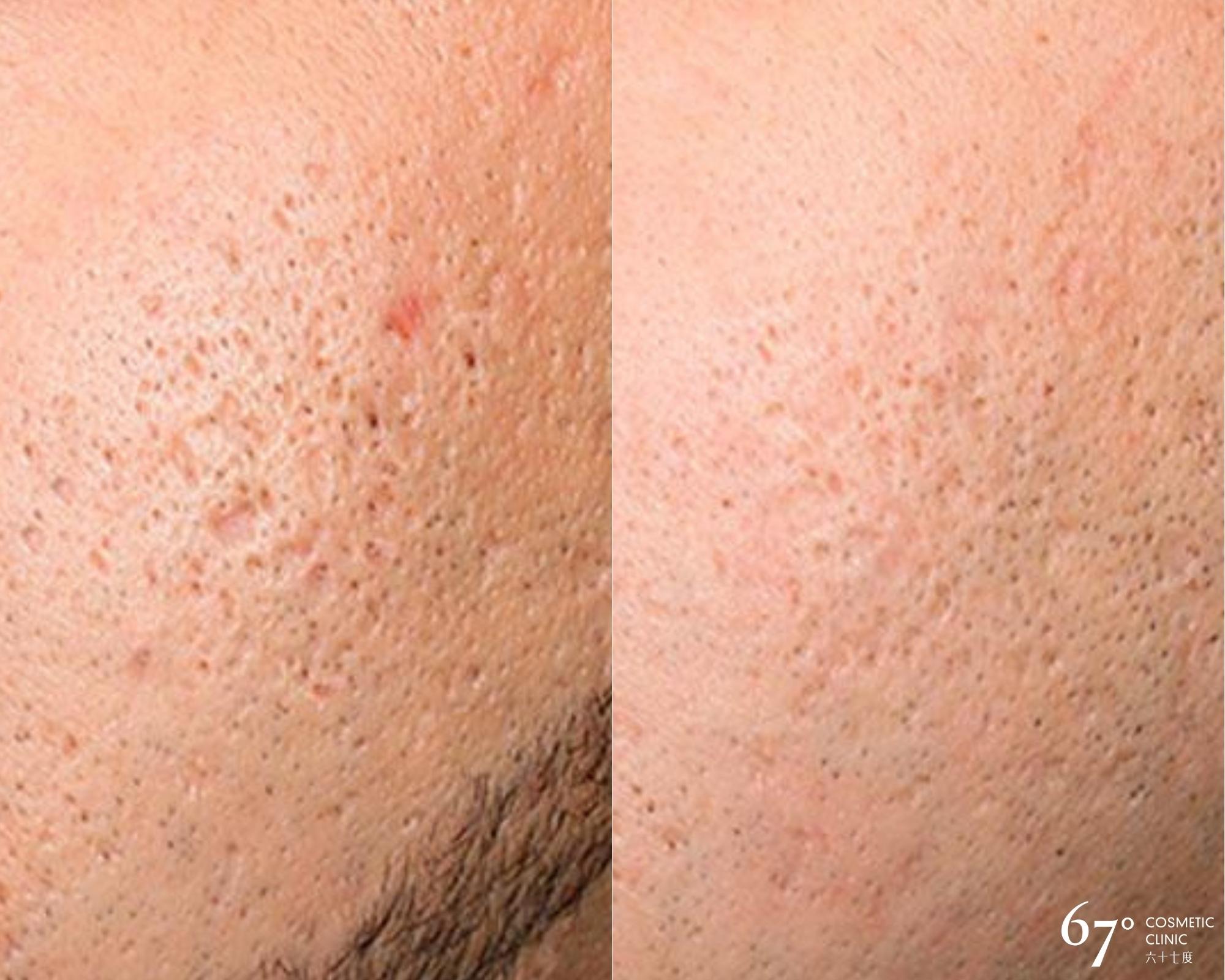 Exceed™ Microneedling - 67 Degrees Cosmetic Clinic