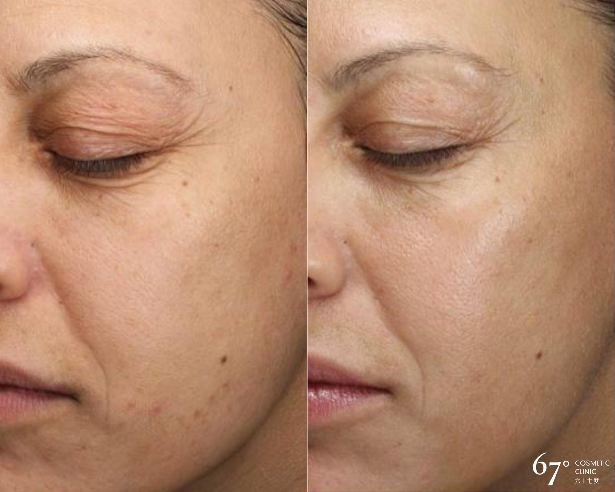 Frax™ - 67 Degrees Cosmetic Clinic